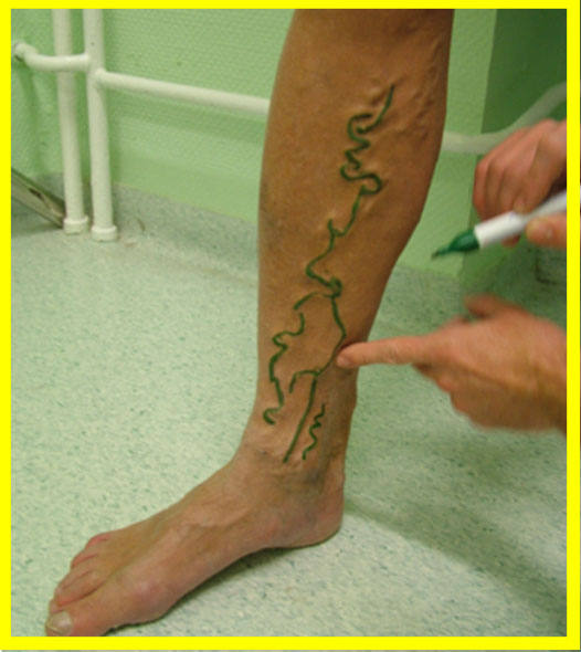 Varikosis Krampfaderleiden | Gefäßchirurgie Berlin