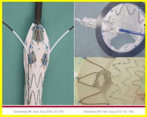 Bauchaortenaneurysma FEVAR – Gefäßchirurgie Berlin