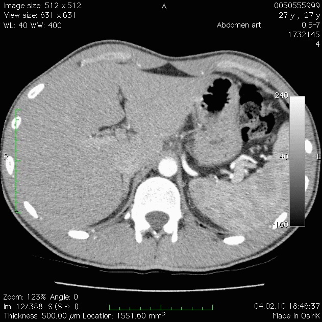 Dunbar-Syndrom-CT – Gefäßchirurgie Berlin