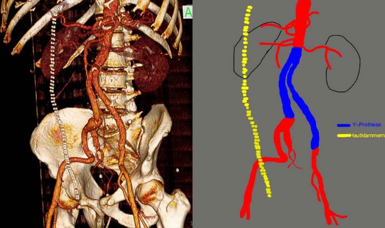 Bauchaortenaneurysma – Gefäßchirurgie Berlin
