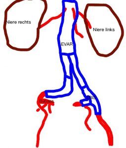 evar-zbis-bypass – Gefäßchirurgie Berlin