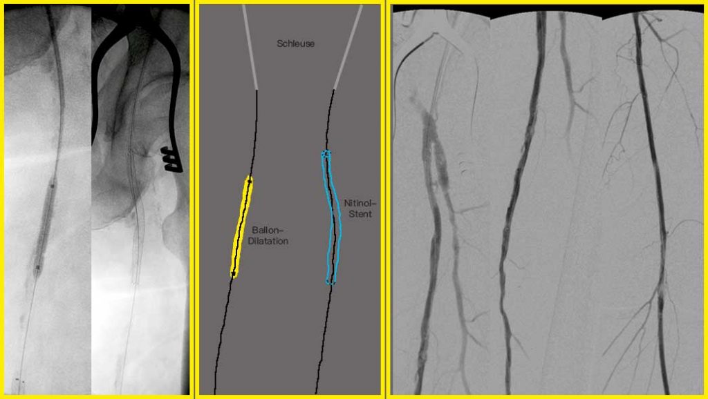 hybrid-eingriff-profundaplastik-pta-stent – Gefäßchirurgie Berlin