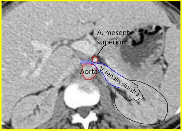 Nussknacker-Syndrom – Gefäßchirurgie Berlin