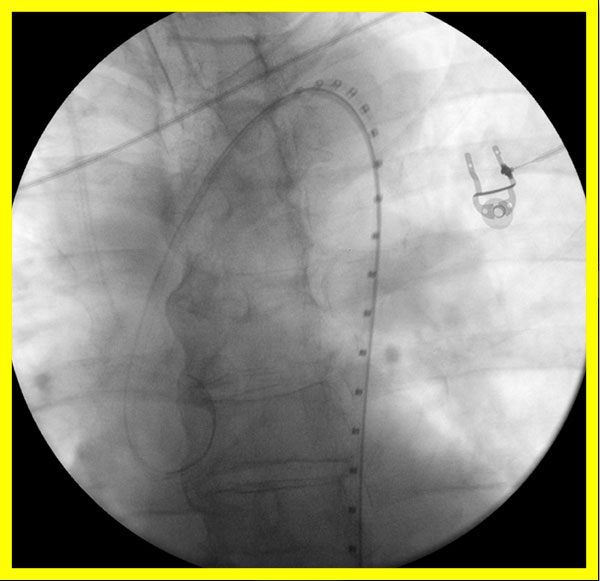 thorakales-aneurysma-tevar – Gefäßchirurgie Berlin